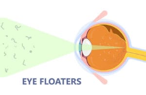 Are Floaters Normal Post-Cataract Surgery? Find Out