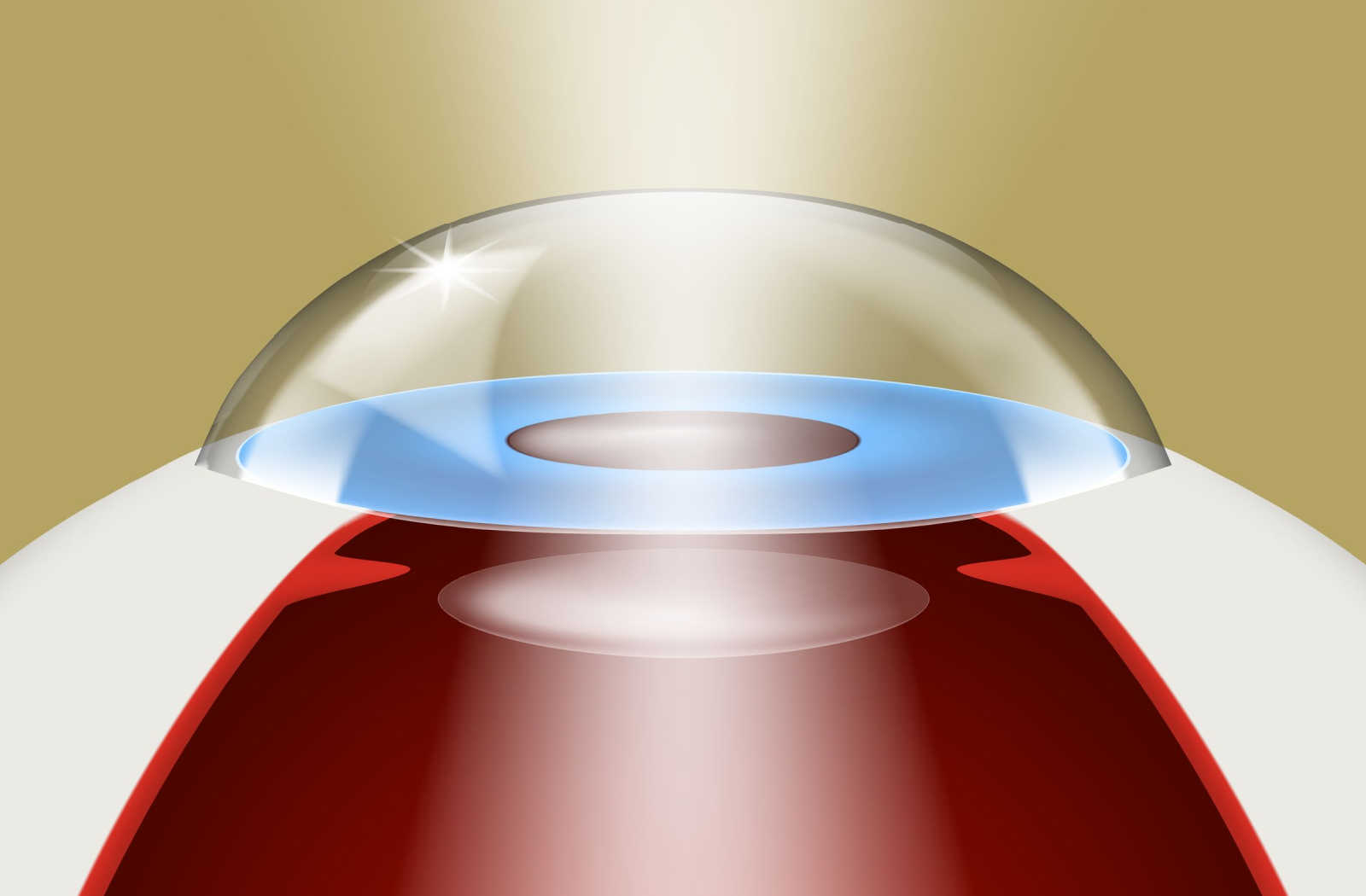 What Is the Light Adjustable Lens (LAL)? | Lake Eye Associates
